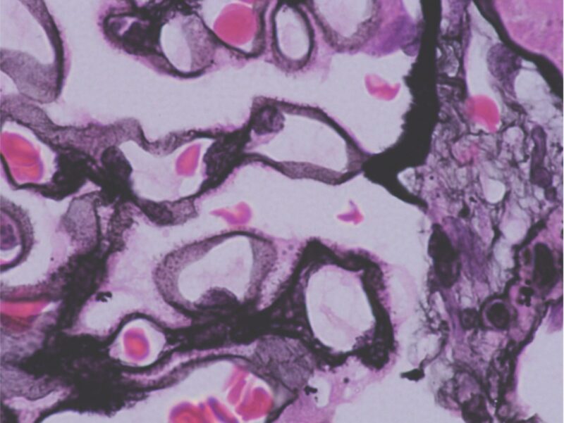 The Pathobiology of Membranous Nephropathy: A histologic pattern of ...