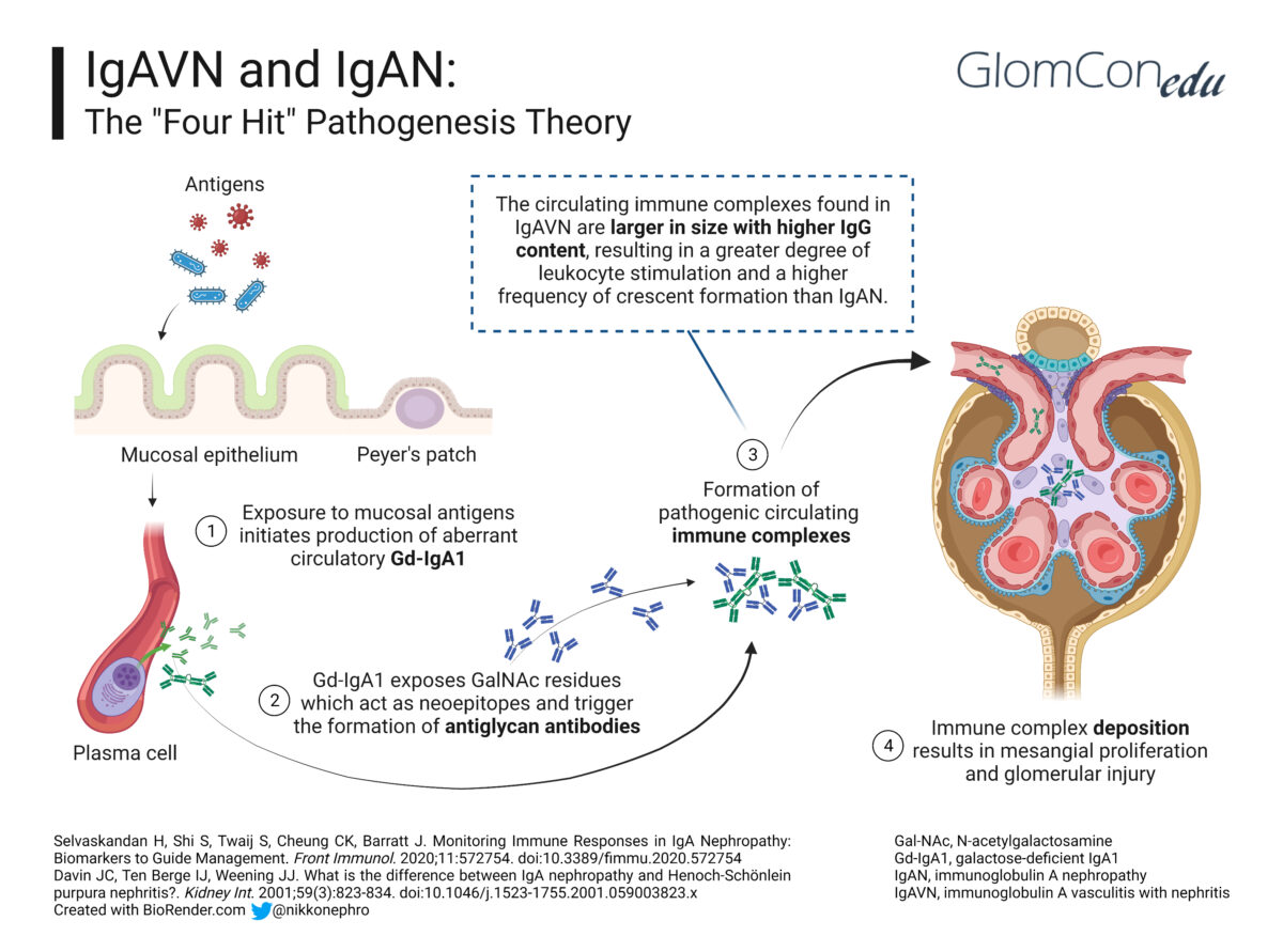 IgA Vasculitis Associated with Nephritis: Mini-Review – GlomCon (pubs)